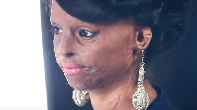 Acid Attack Model
