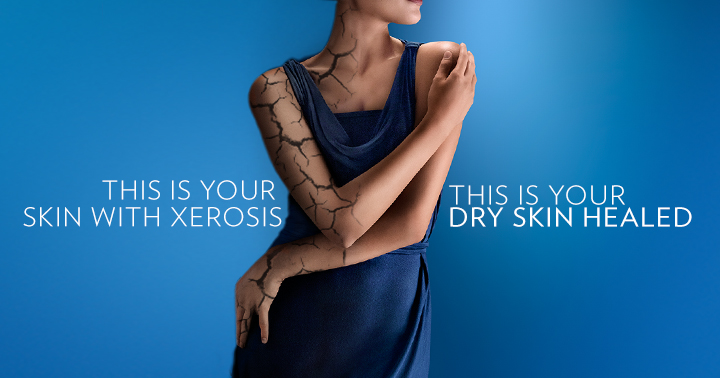 Skin Problems You Can Get From Xerosis